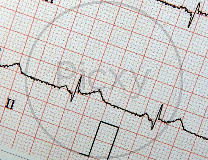Image of Ecg Output Printout Of A Heart Rate Or Pulse Wave Measurement ...