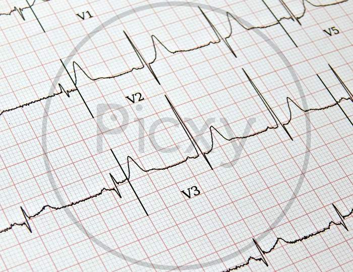 Image of View Of Ecg Or Heart Beat Or Health Details Print Out Report ...