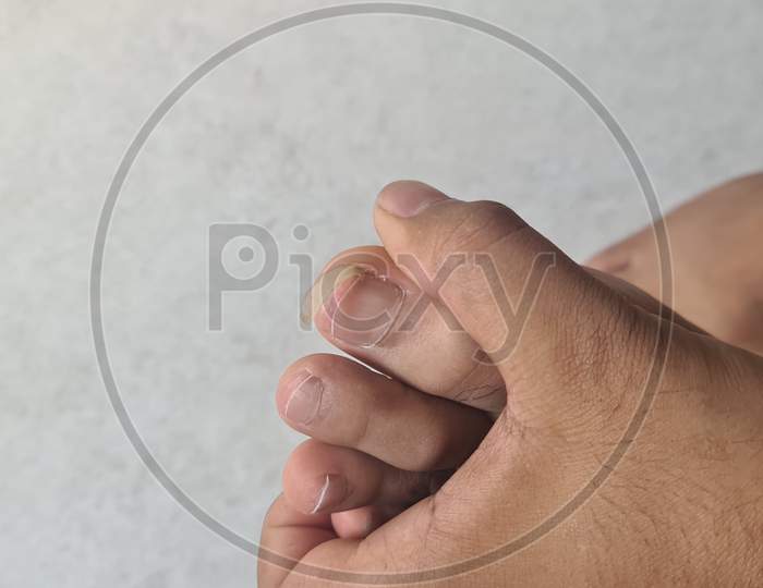 Image of Foot With Damaged Nails Dorsal, Callus, Corn, Because Of ...