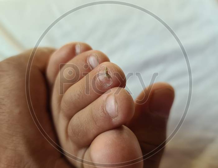 Image of Foot With Damaged Nails Dorsal, Callus, Corn, Because Of ...