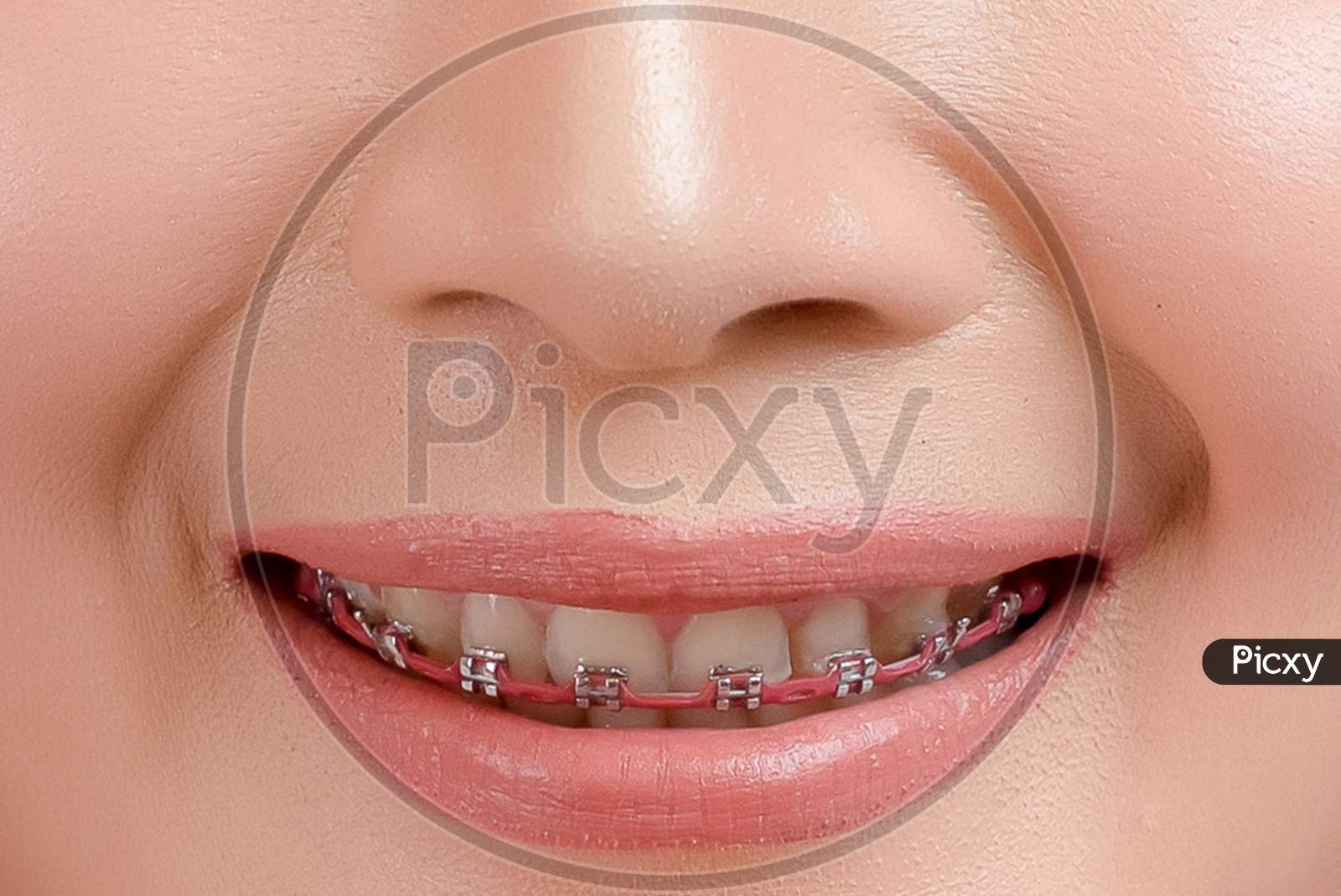 Image of Close up Braces on Teeth. Braces Smile. Orthodontic Treatment ...