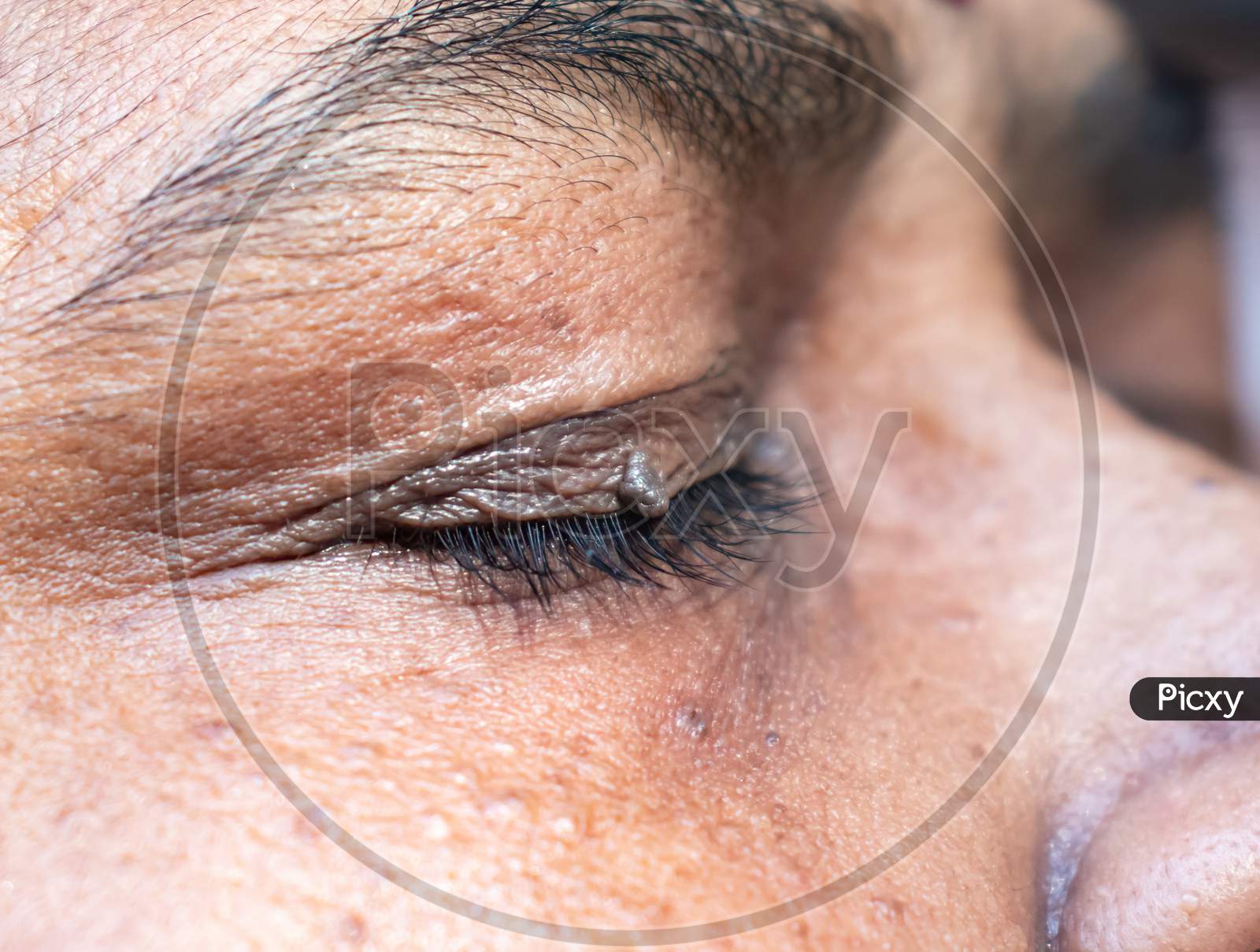 Image of Wart Or Mole In The Eye Lid Of A Human.-RY249230-Picxy